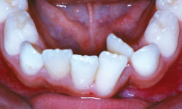 Common problems at Dr Zoey Orthodontics in Vero Beach FL
