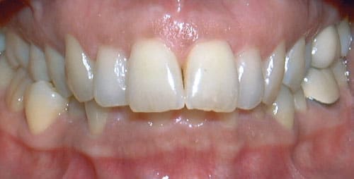Common problems at Dr Zoey Orthodontics in Vero Beach FL
